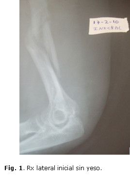 Tratamiento conservador de la fractura diafisaria de húmero ...