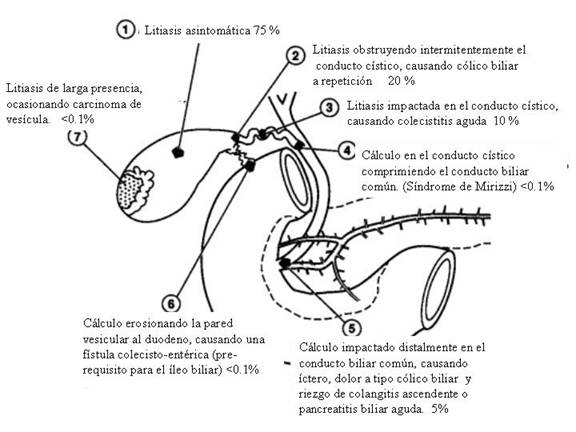 Litiasis vesicular indicación del tratamiento quirúrgico. Nuevos ...