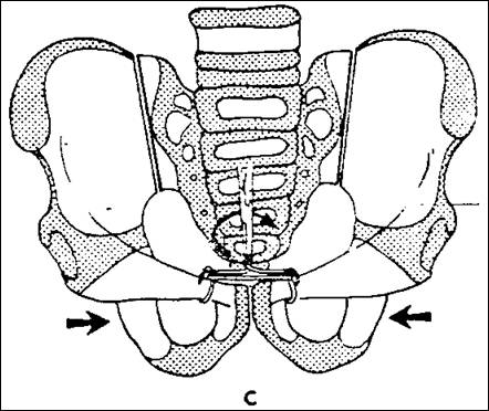 Extrofia Vesical. Difícil y complicado tratamiento en el campo de la ...