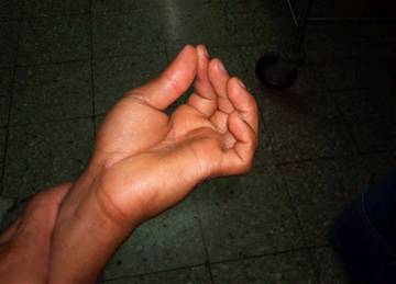 Parálisis del nervio interóseo anterior. Síndrome de Nevin-Kiloh ...