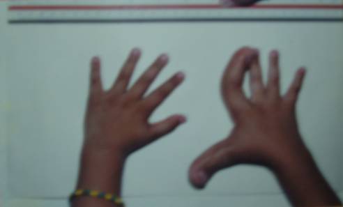 Macrodactilia. Epifisiodesis con minigrapas. Presentación de un caso ...