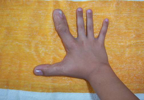 Macrodactilia. Epifisiodesis con minigrapas. Presentación de un caso ...