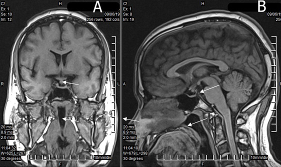 Diabetes insípida, panhipofisitis y silla turca vacía. Presentación de ...