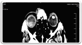 Panoftalmitis: presentación atípica de un melanoma coroideo | Menéndez ...