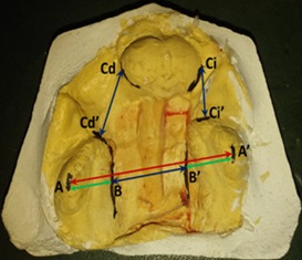 Efectos del moldeo nasoalveolar y la adhesión labial en el tratamiento ...