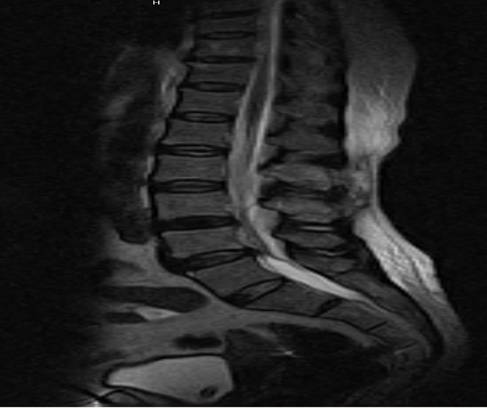 Absceso Espinal Epidural secundario a bloqueo terapéutico. Presentación ...