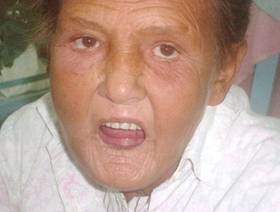 Síndrome de CREST. Presentación de un caso | Acosta Piedra | Revista ...