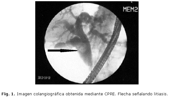 Síndrome de Mirizzi tipo IV: diagnóstico y manejo mediante ...